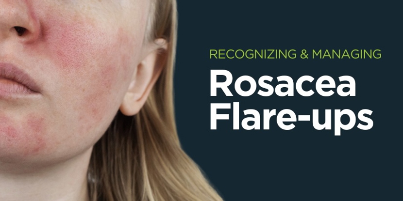 Utah Rosacea, Treatment, Solutions, V-Beam Laser | Ogden Clinic