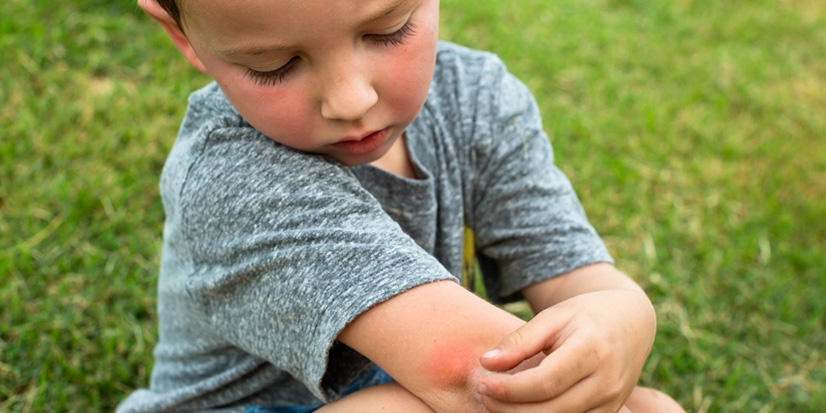 The Best Ways to Handle Bee Stings and Mosquito Bites - Healthy You