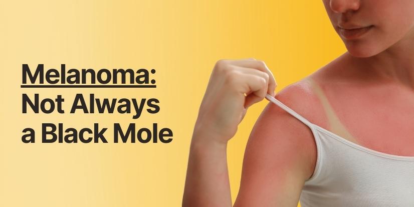 Lesser Known Facts about Melanoma: Not Always a Black Mole