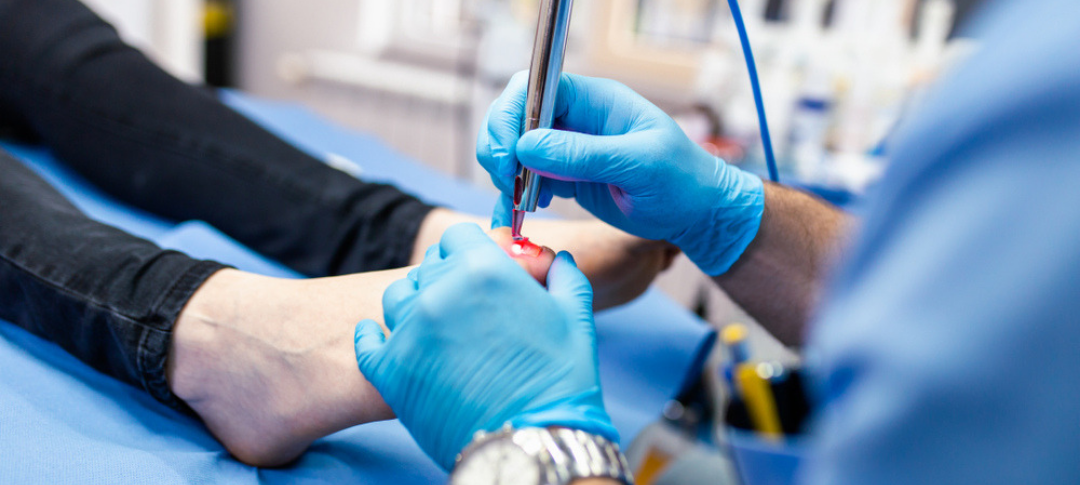 This Laser Treatment for Toenail Fungus Boasts Incredible Outcomes ...